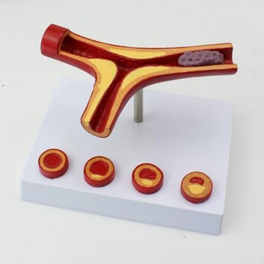 Human Vessel Anatomical Model Atherosclerosis Model Medical Training M ...